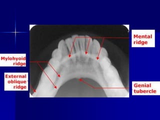 Genial Tubercles Xray