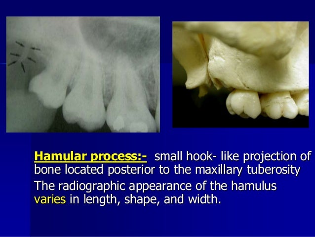 Hamular Process Pterygoid Hamulus Wikipedia