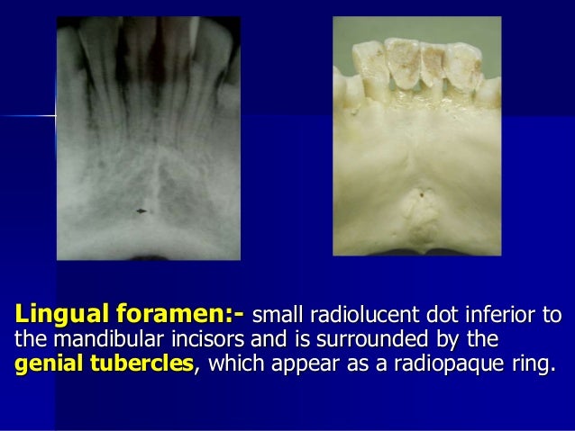 Lingual Foramen And Genial Tubercle 22 Recognizing Normal Radiographic