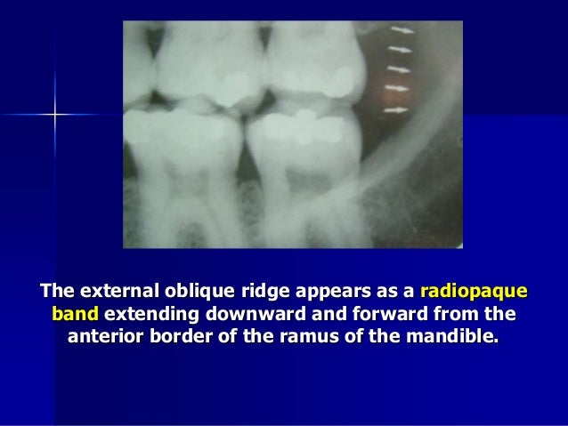 External Oblique Ridge