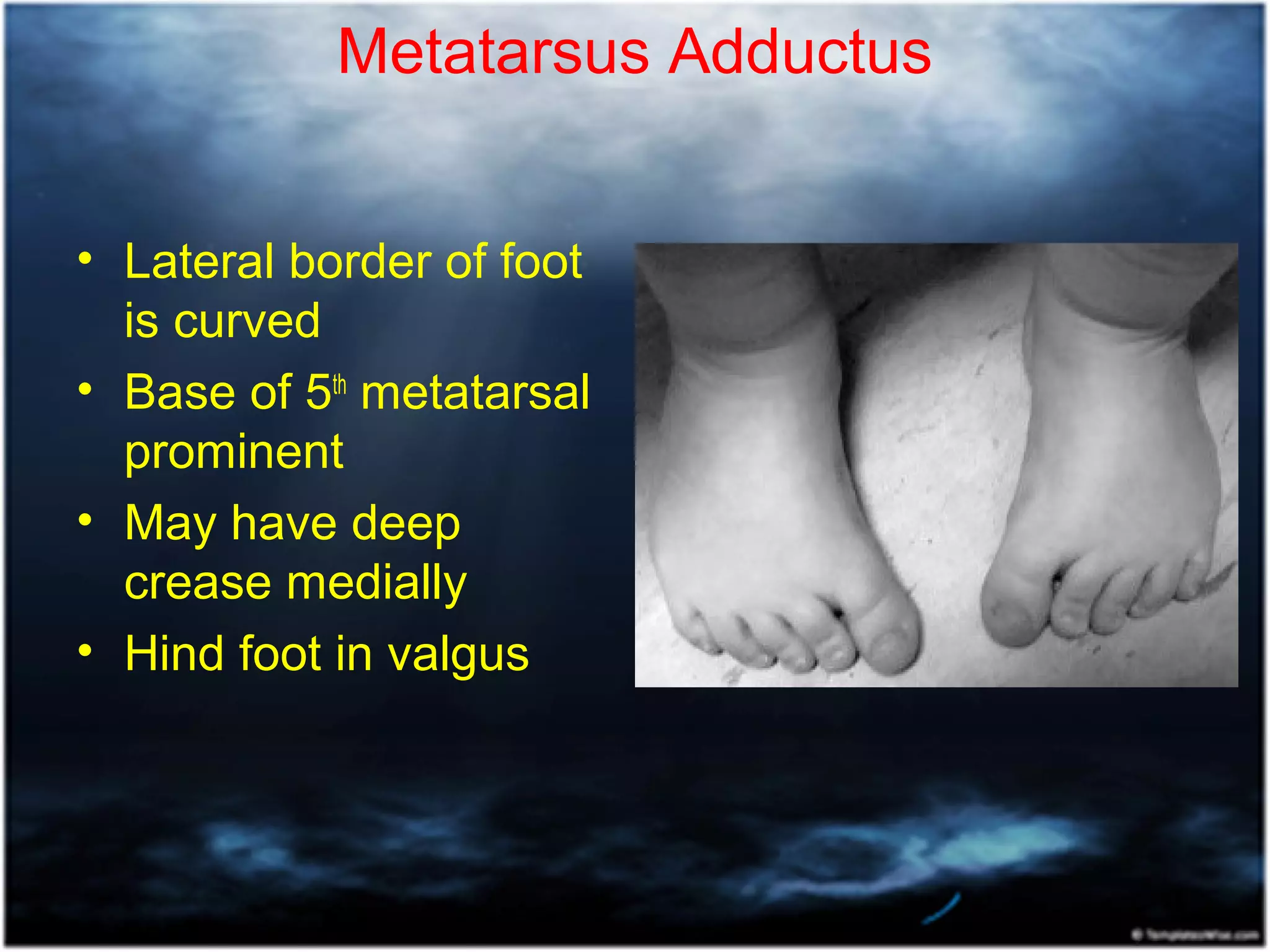 Rotational deformities of lower extremity in children | PPT