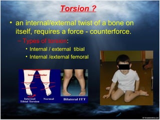 Tibial Internal Rotation