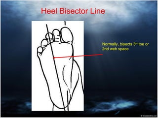 Rotational deformities of lower extremity in children | PPT