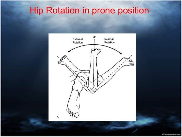 Rotational deformities of lower extremity in children