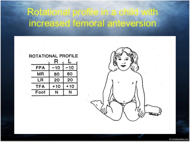 Rotational deformities of lower extremity in children