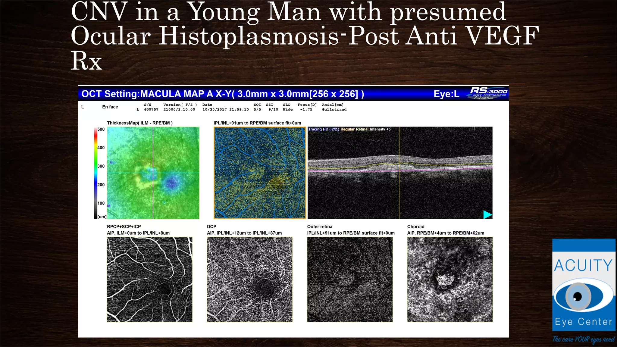 OCTA (OCT Angiography) Strengths and Limitations | PDF