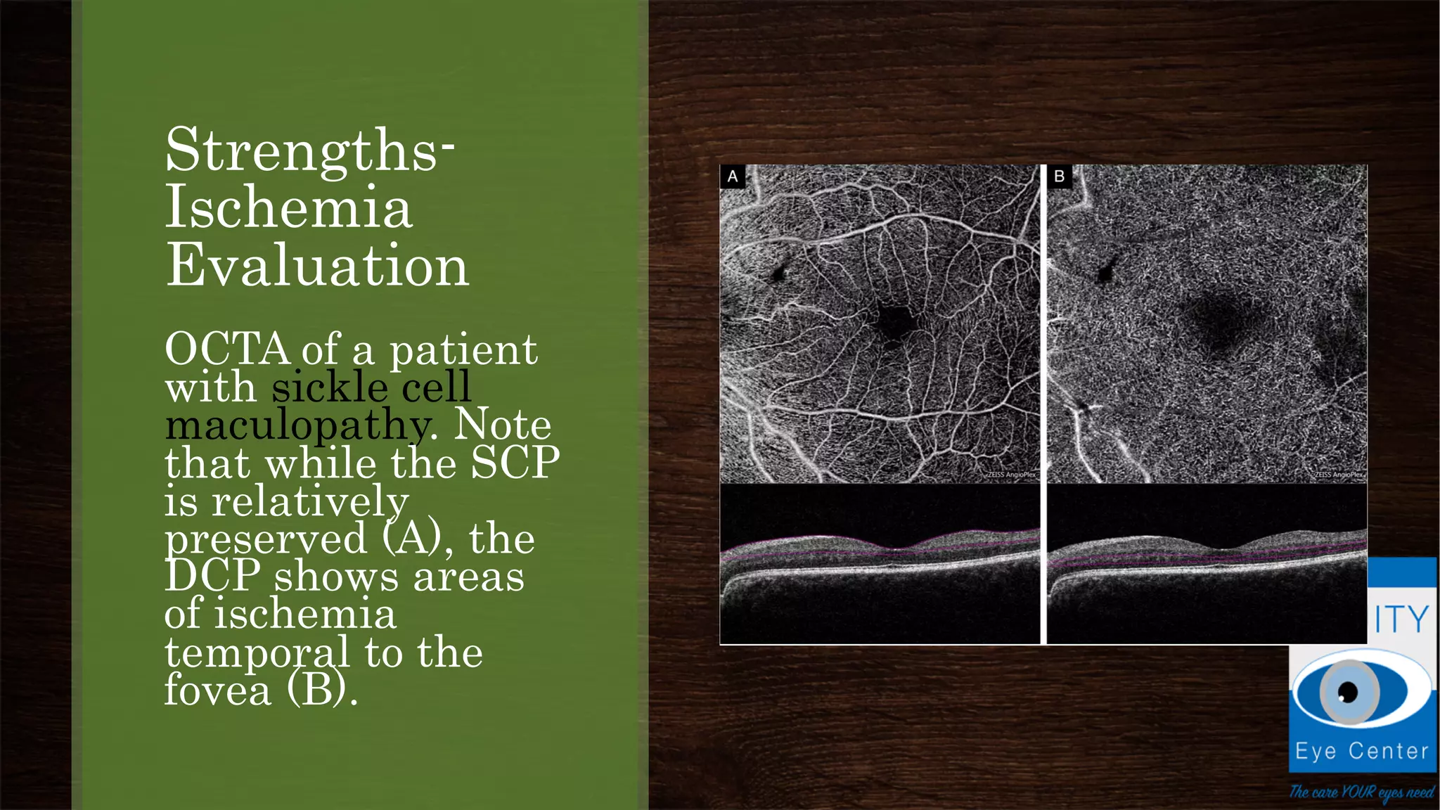 OCTA (OCT Angiography) Strengths and Limitations | PDF