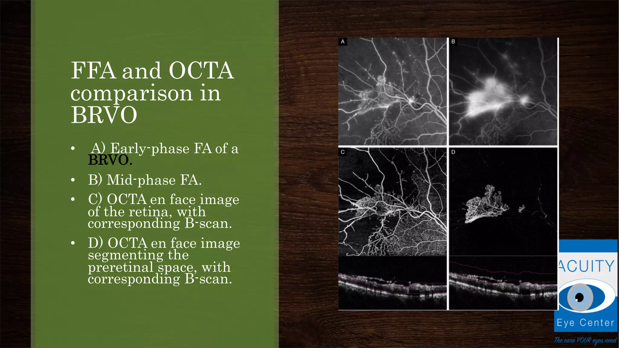 OCTA (OCT Angiography) Strengths and Limitations | PDF