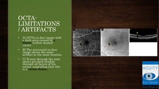 OCTA (OCT Angiography) Strengths and Limitations | PDF
