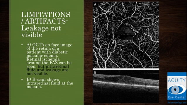 OCTA (OCT Angiography) Strengths and Limitations | PDF | Eye and Vision ...