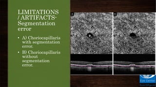 OCTA (OCT Angiography) Strengths and Limitations | PDF