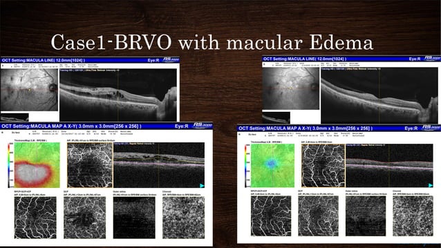 OCTA (OCT Angiography) Strengths and Limitations | PDF | Eye and Vision ...