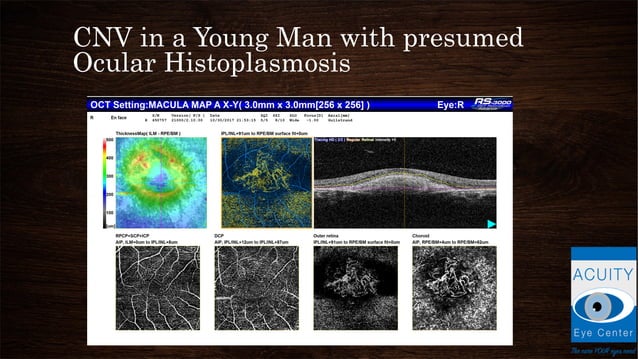 OCTA (OCT Angiography) Strengths and Limitations | PDF | Eye and Vision ...