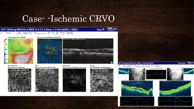 OCTA (OCT Angiography) Strengths and Limitations | PDF | Eye and Vision ...