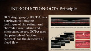 OCTA (OCT Angiography) Strengths and Limitations | PDF