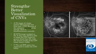 OCTA (OCT Angiography) Strengths and Limitations | PDF