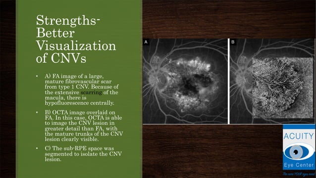 OCTA (OCT Angiography) Strengths and Limitations | PDF | Eye and Vision ...