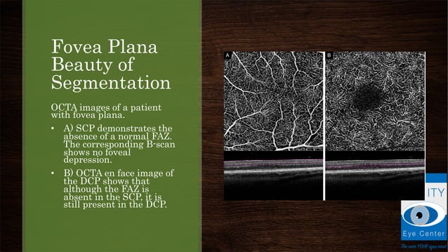OCTA (OCT Angiography) Strengths and Limitations | PDF | Eye and Vision ...