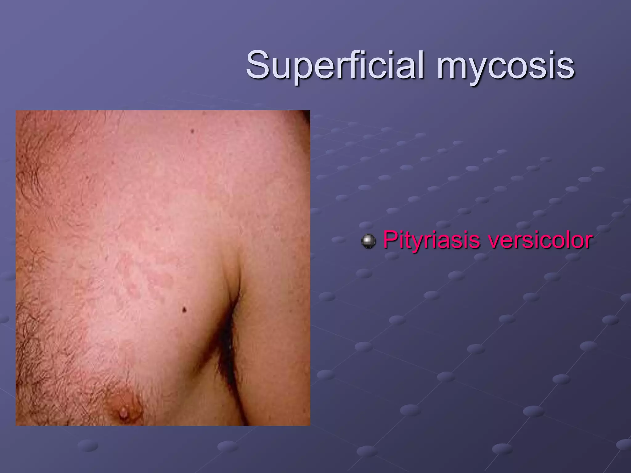 3-Superficial_mycosis__dee239cd.ppt
