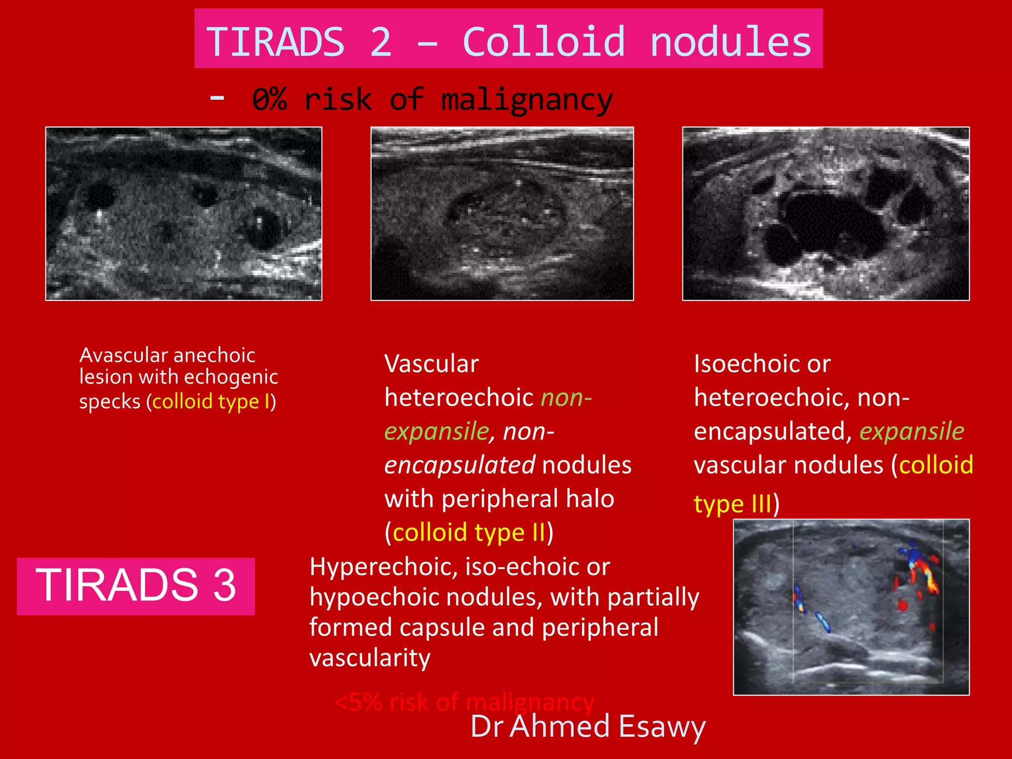 thyriod gland imaging part 3 (benign malignant thyriod nodule) Dr Ahmed ...