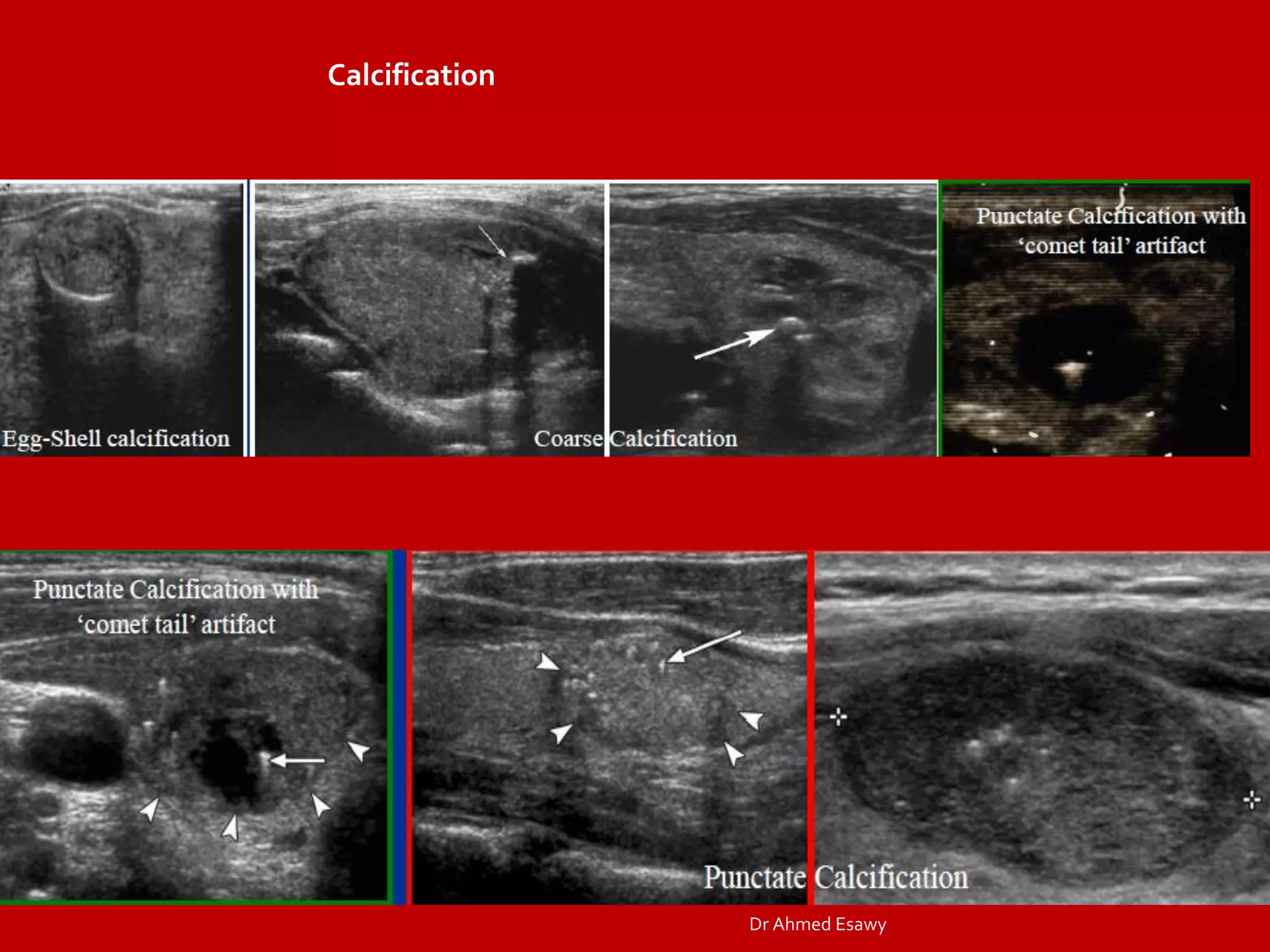 thyriod gland imaging part 3 (benign malignant thyriod nodule) Dr Ahmed ...