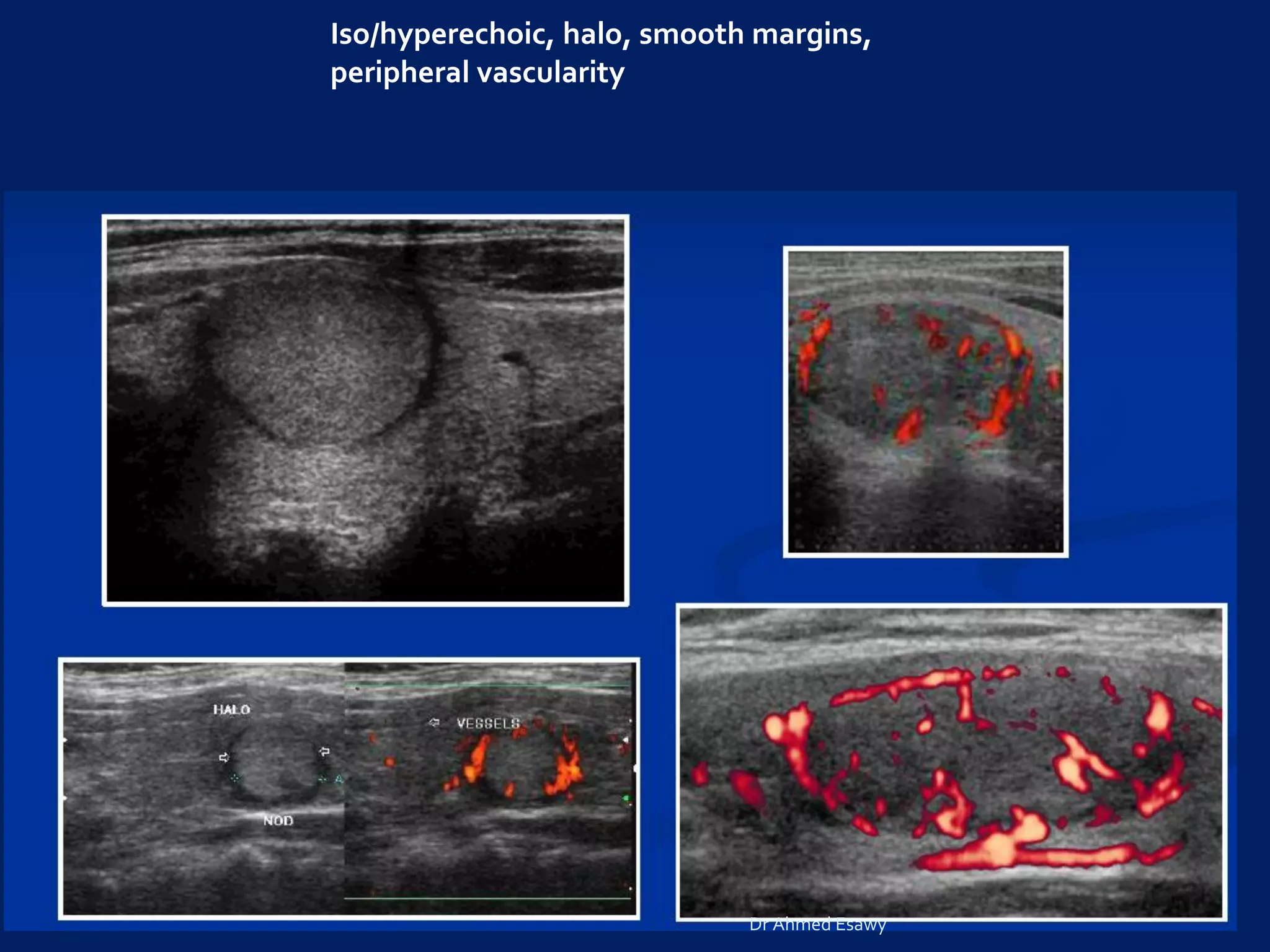thyriod gland imaging part 3 (benign malignant thyriod nodule) Dr Ahmed ...