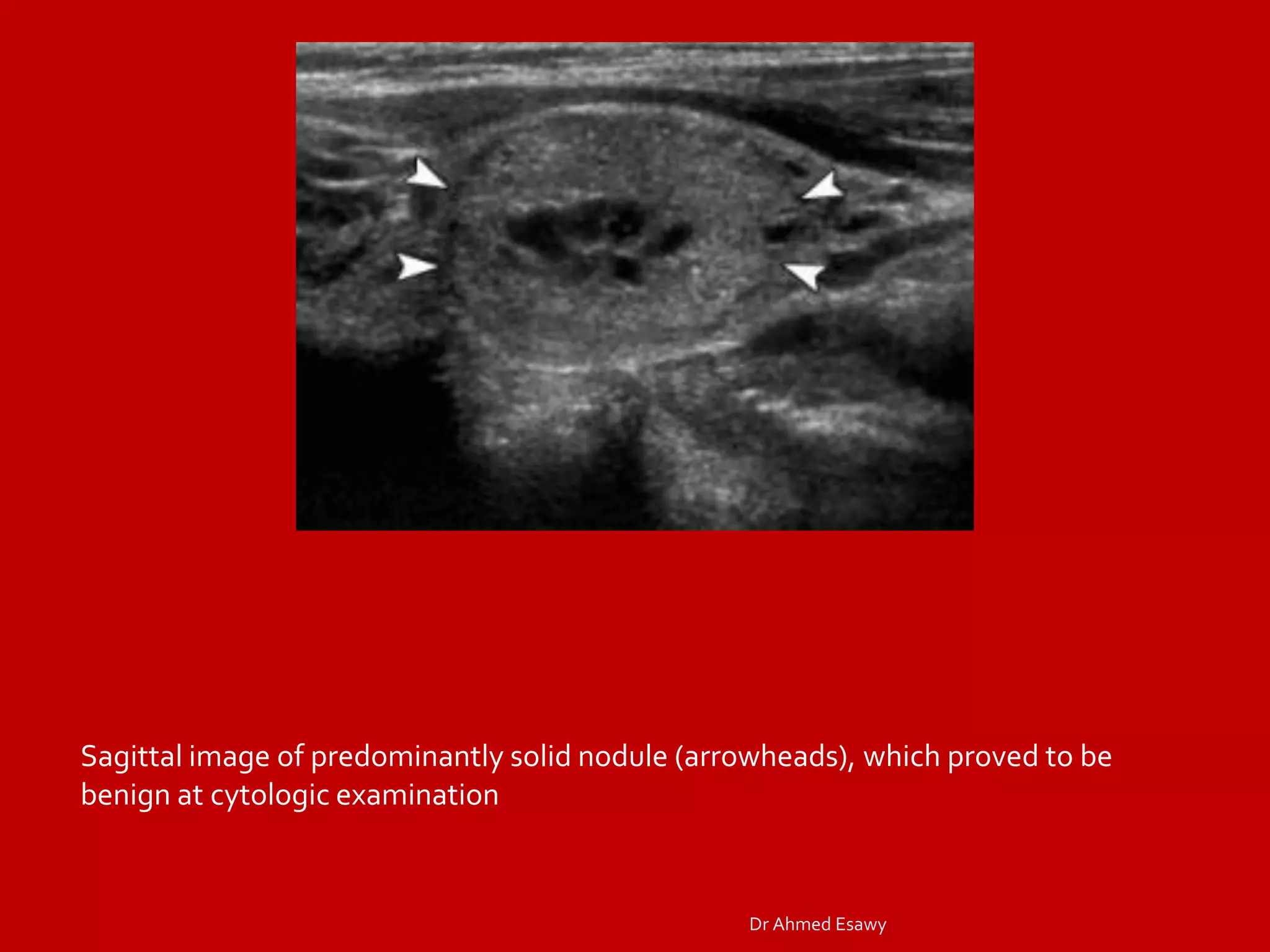 thyriod gland imaging part 3 (benign malignant thyriod nodule) Dr Ahmed ...