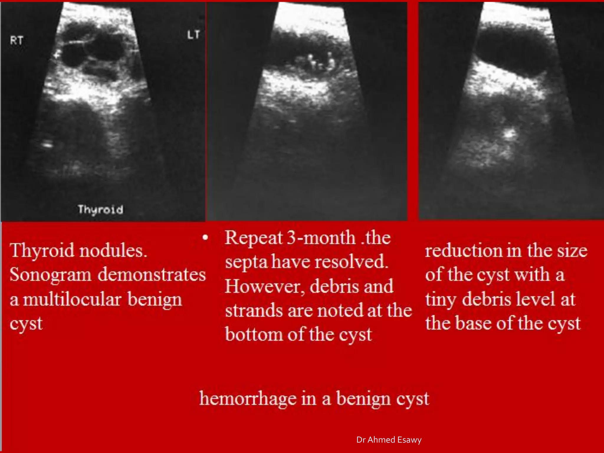 thyriod gland imaging part 3 (benign malignant thyriod nodule) Dr Ahmed ...