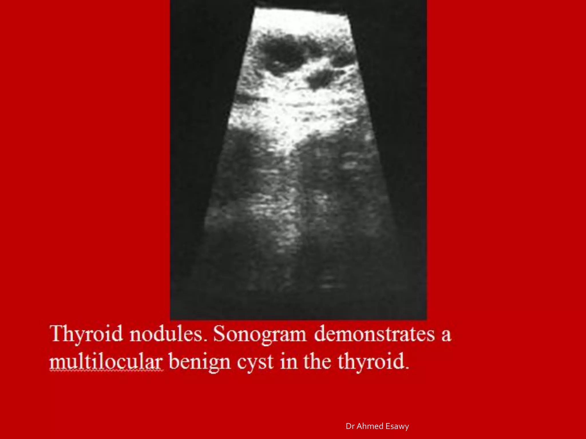 thyriod gland imaging part 3 (benign malignant thyriod nodule) Dr Ahmed ...