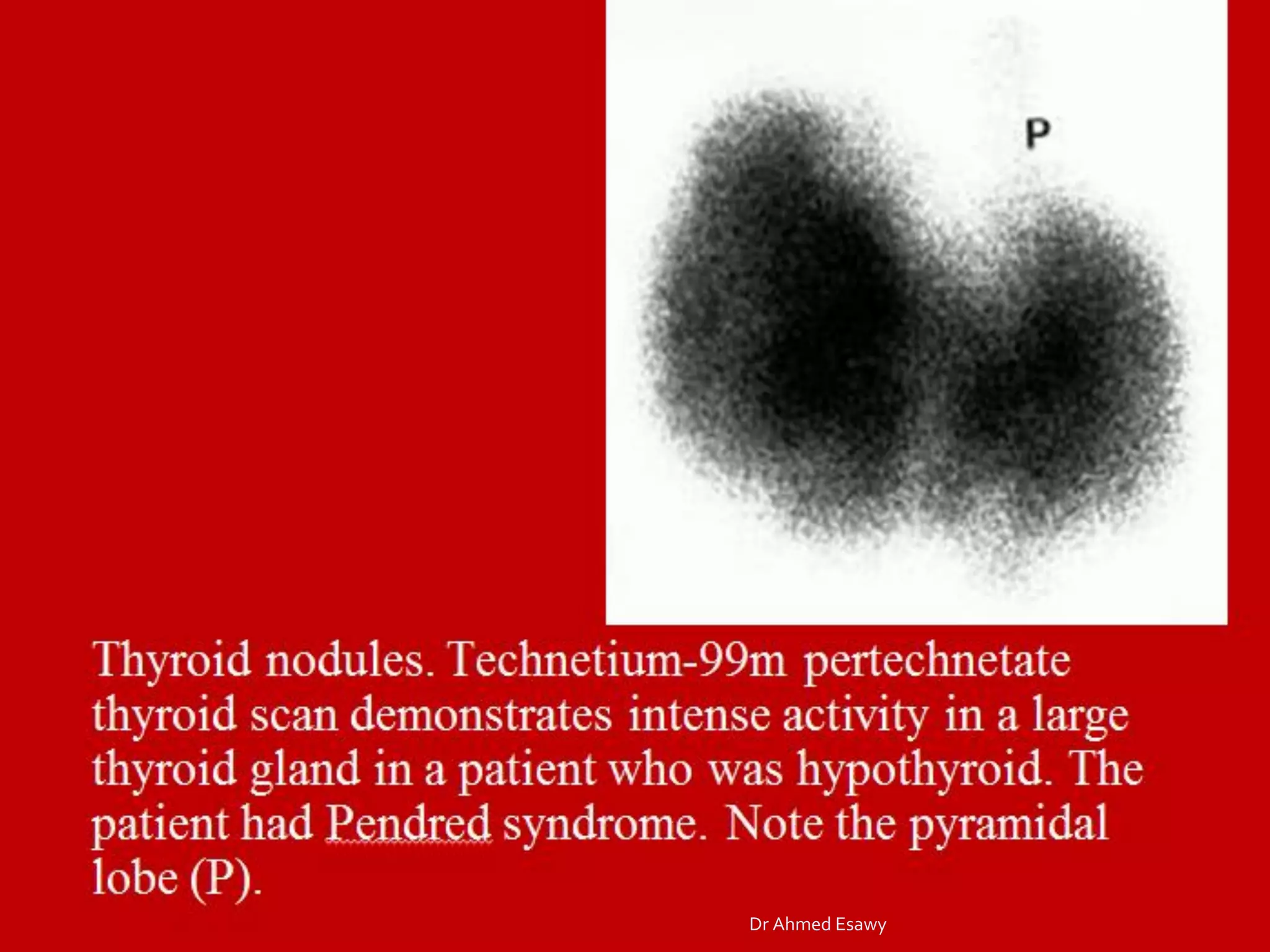 thyriod gland imaging part 3 (benign malignant thyriod nodule) Dr Ahmed ...