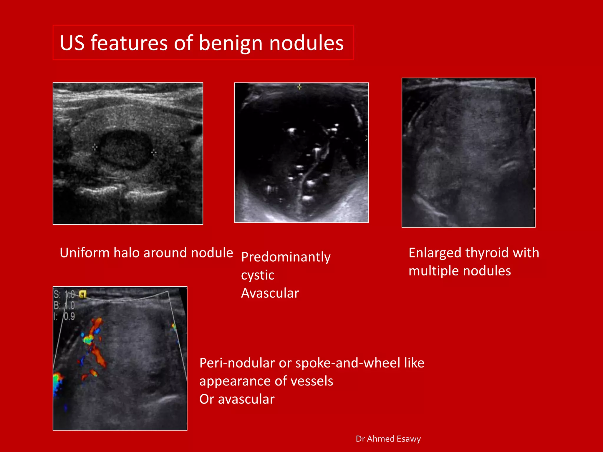 thyriod gland imaging part 3 (benign malignant thyriod nodule) Dr Ahmed Esawy | PDF | Thyroid ...