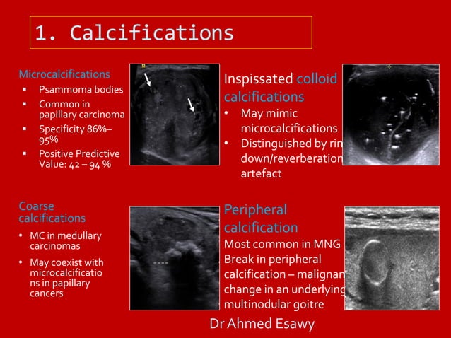 thyriod gland imaging part 3 (benign malignant thyriod nodule) Dr Ahmed ...