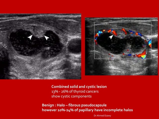 thyriod gland imaging part 3 (benign malignant thyriod nodule) Dr Ahmed ...