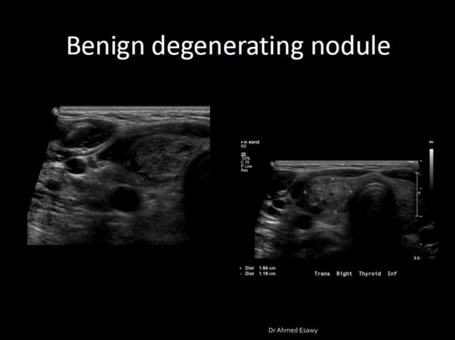 thyriod gland imaging part 3 (benign malignant thyriod nodule) Dr Ahmed ...