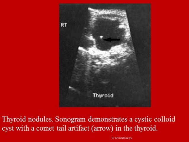 thyriod gland imaging part 3 (benign malignant thyriod nodule) Dr Ahmed ...