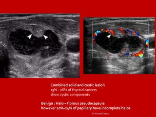 thyriod gland imaging part 3 (benign malignant thyriod nodule) Dr Ahmed ...