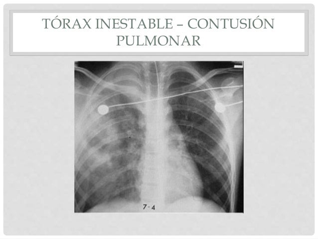 Contusion Pulmonar