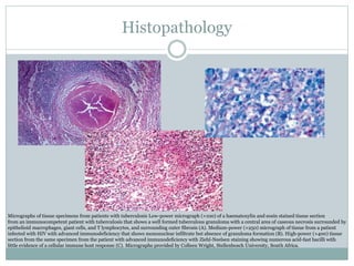 Impact of tuberculosis pathogenesis and management | PPTX
