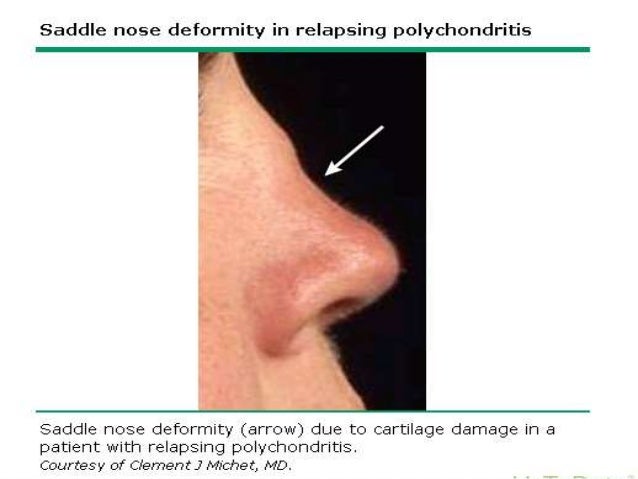 Wegener's Granulomatosis