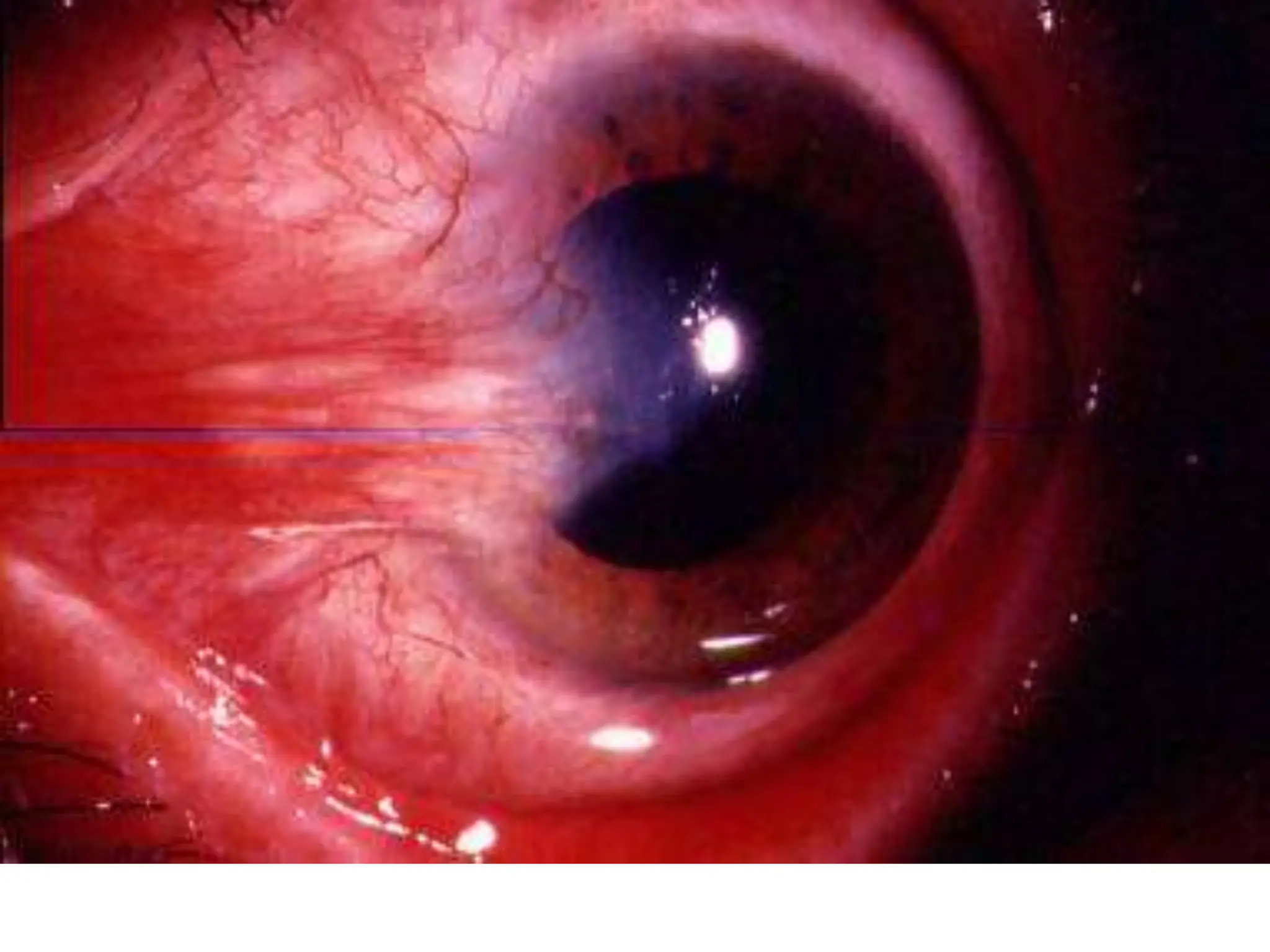 Oftalmologia : Sindrome de Ojo Rojo - Evaluacion y Manejo | PPT | Eye ...