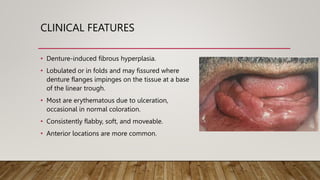 30. Connective Tissue Oral Lesions (1).pptx