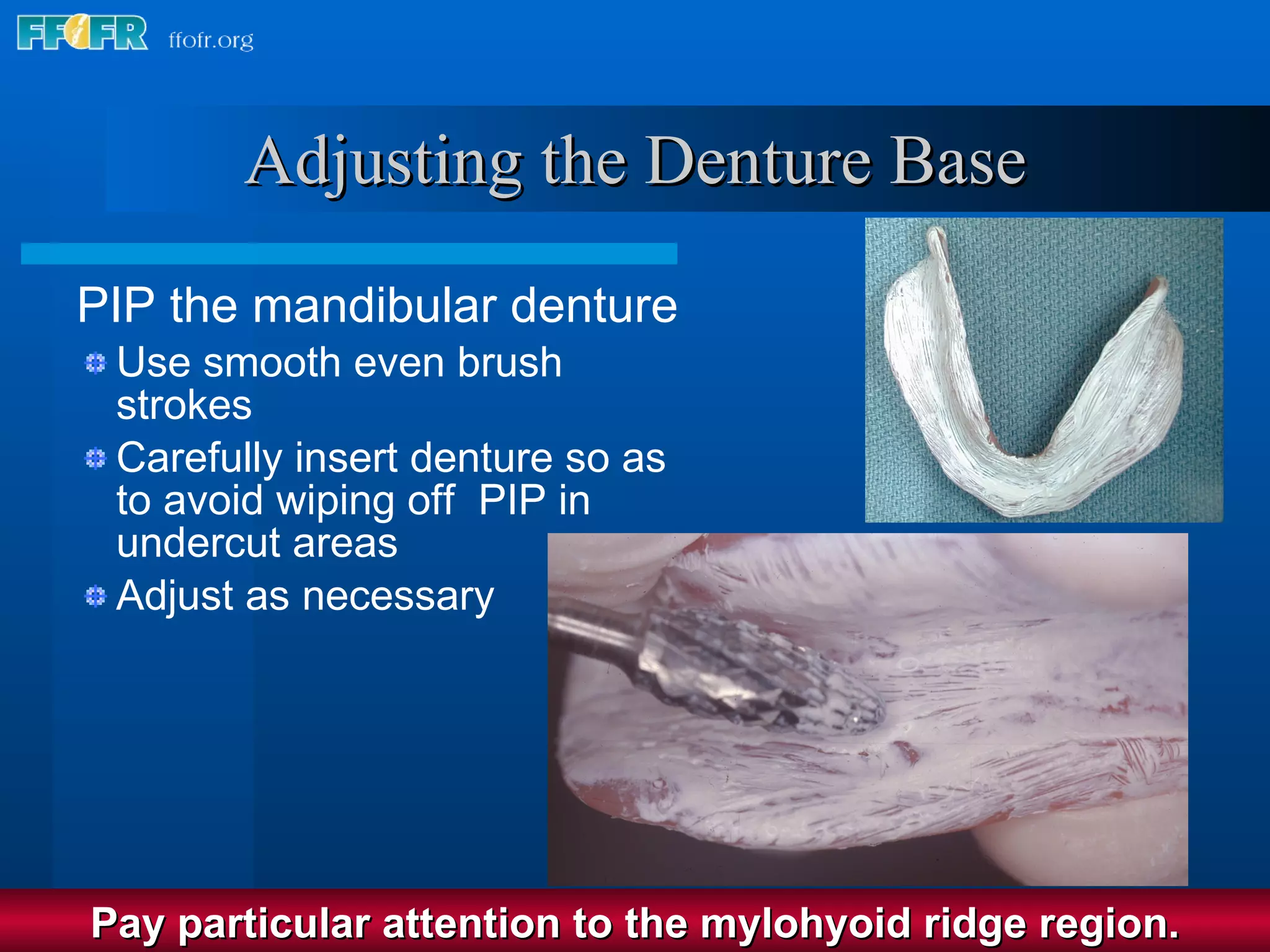 30.insertion and followup | PPT
