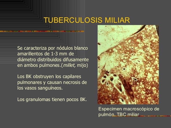 30. tuberculosis extrapulmonar