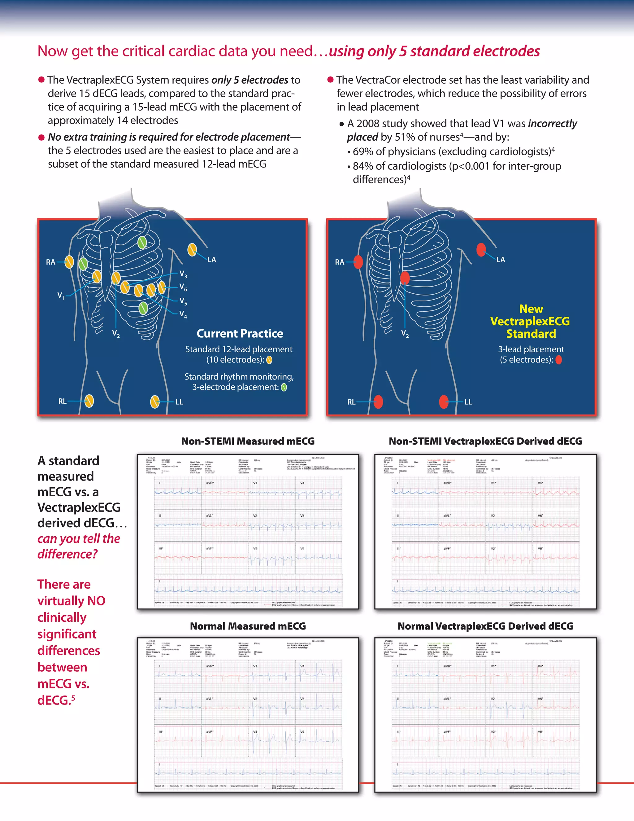 VectraplexECGFinal Brochure 3.1 | PDF