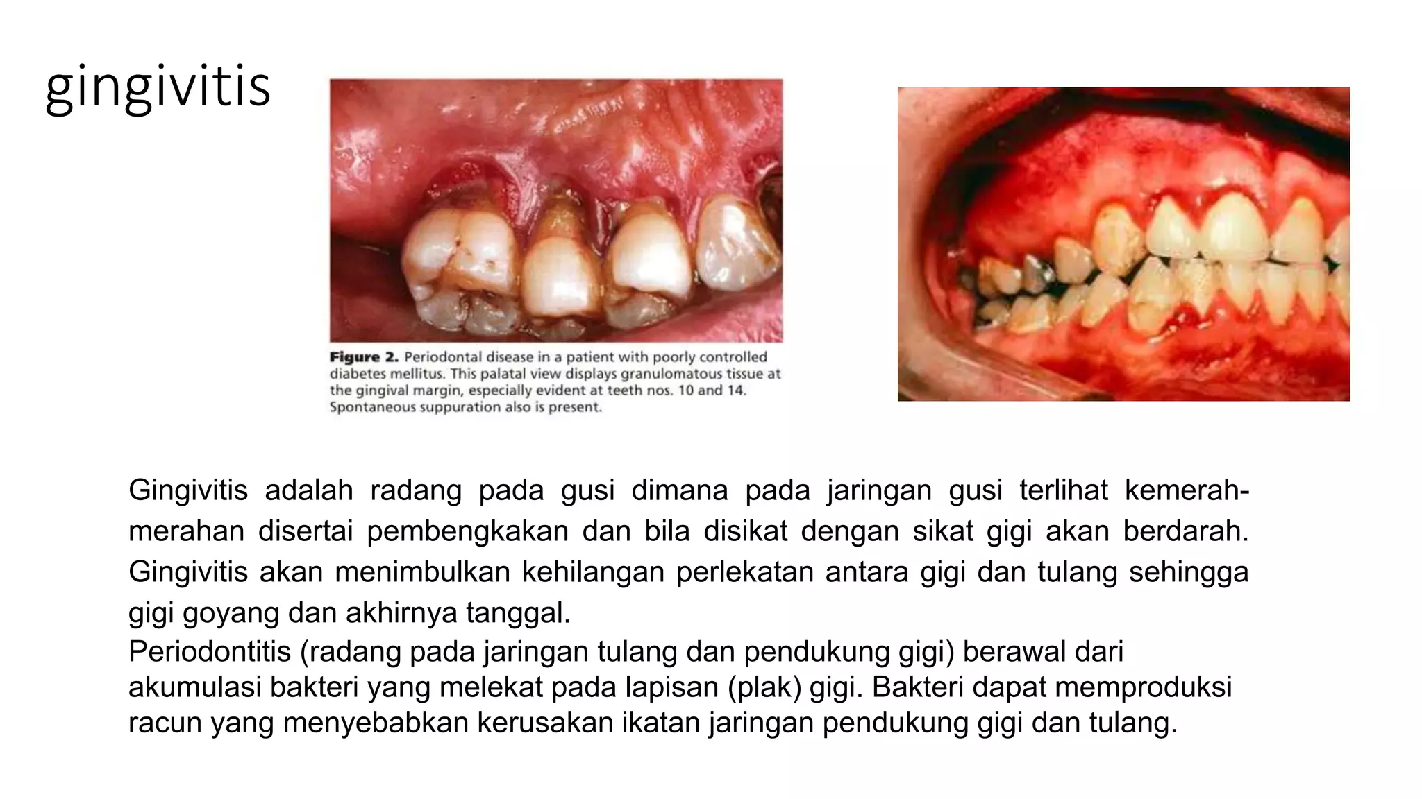 Penyuluhan-Gigi-Prolanis.ppt