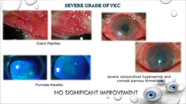 Topical Cyclosporine 0.1% In The Treatment Of Vernal Catarrh