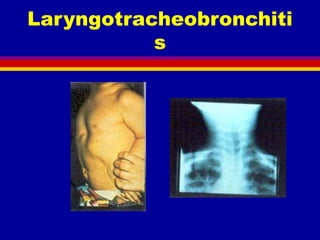 30984_croup.ppt croup also called Acute Laryngotracheobronchitis | PPT