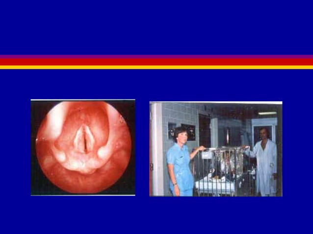 30984_croup.ppt croup also called Acute Laryngotracheobronchitis | PPT