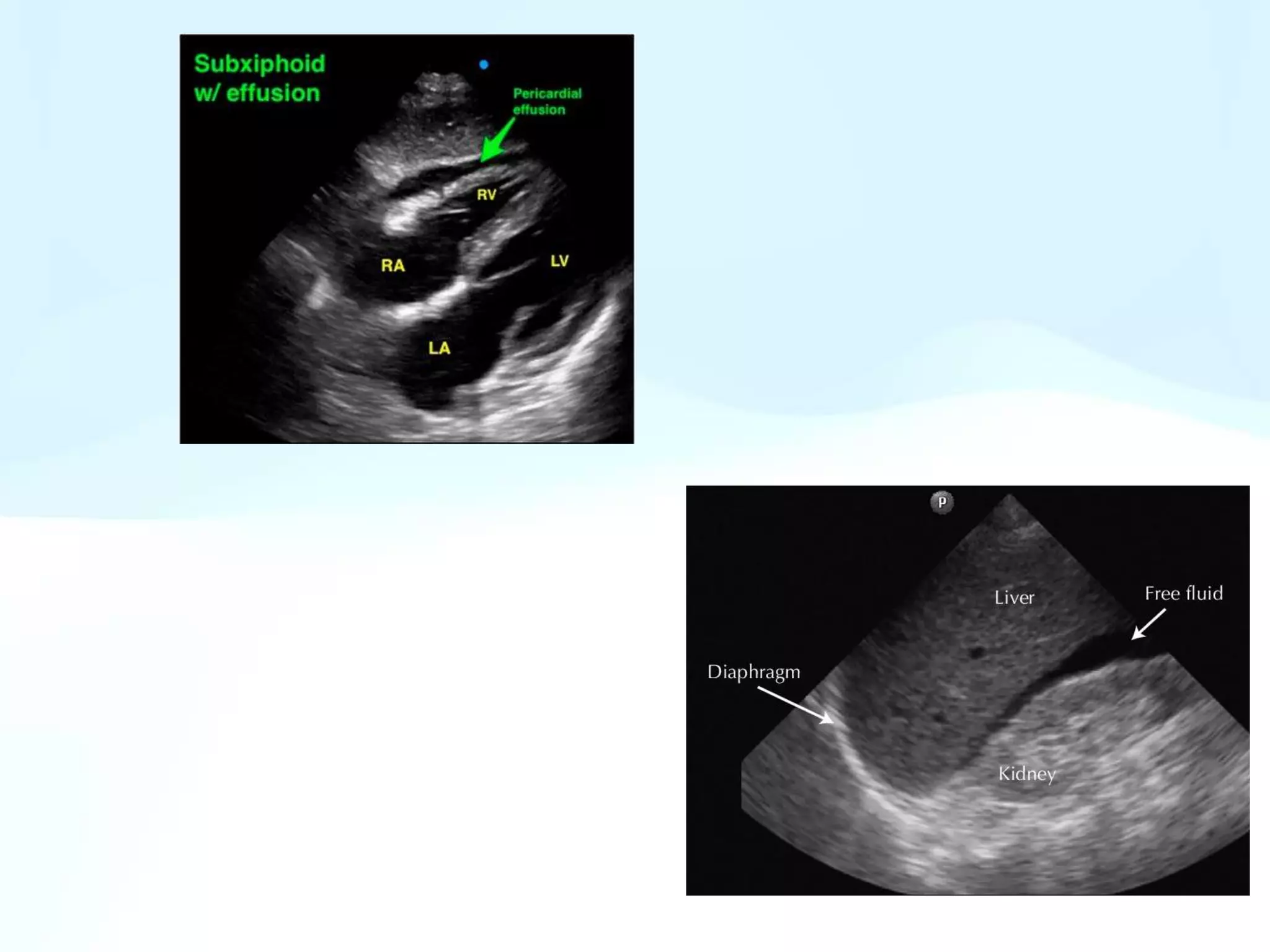 FAST focused assessment with sonography for trauma | PPTX