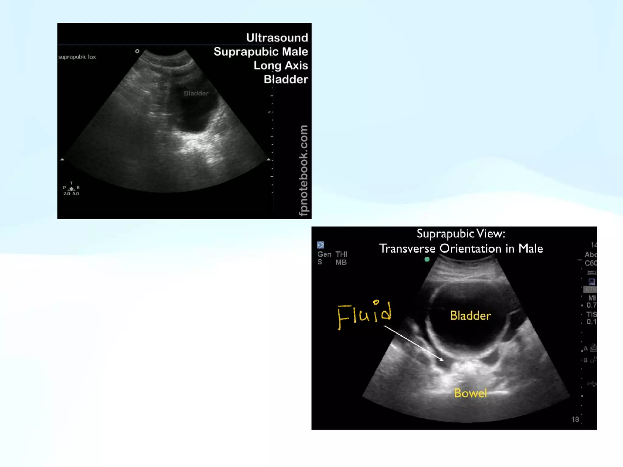 FAST focused assessment with sonography for trauma | PPTX